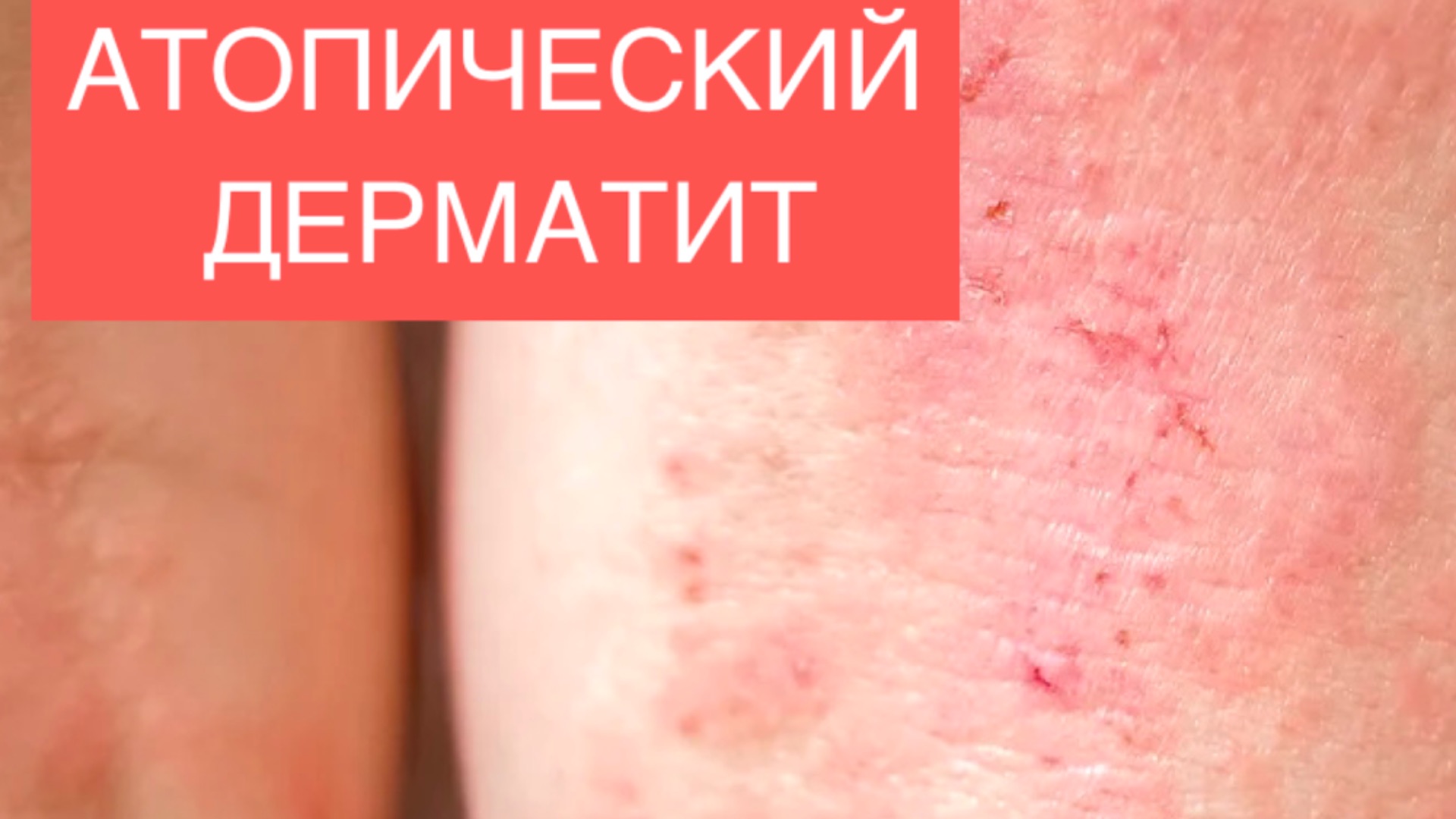 АТОПИЧЕСКИЙ ДЕРМАТИТ