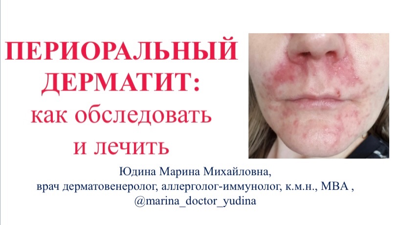 ПЕРИОРАЛЬНЫЙ ДЕРМАТИТ