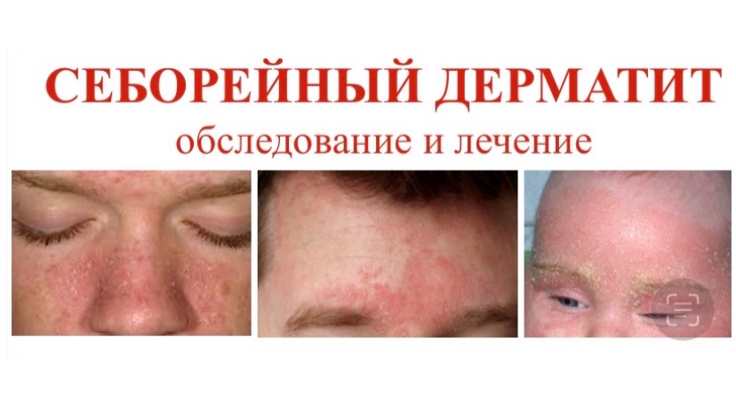 СЕБОРЕЙНЫЙ ДЕРМАТИТ