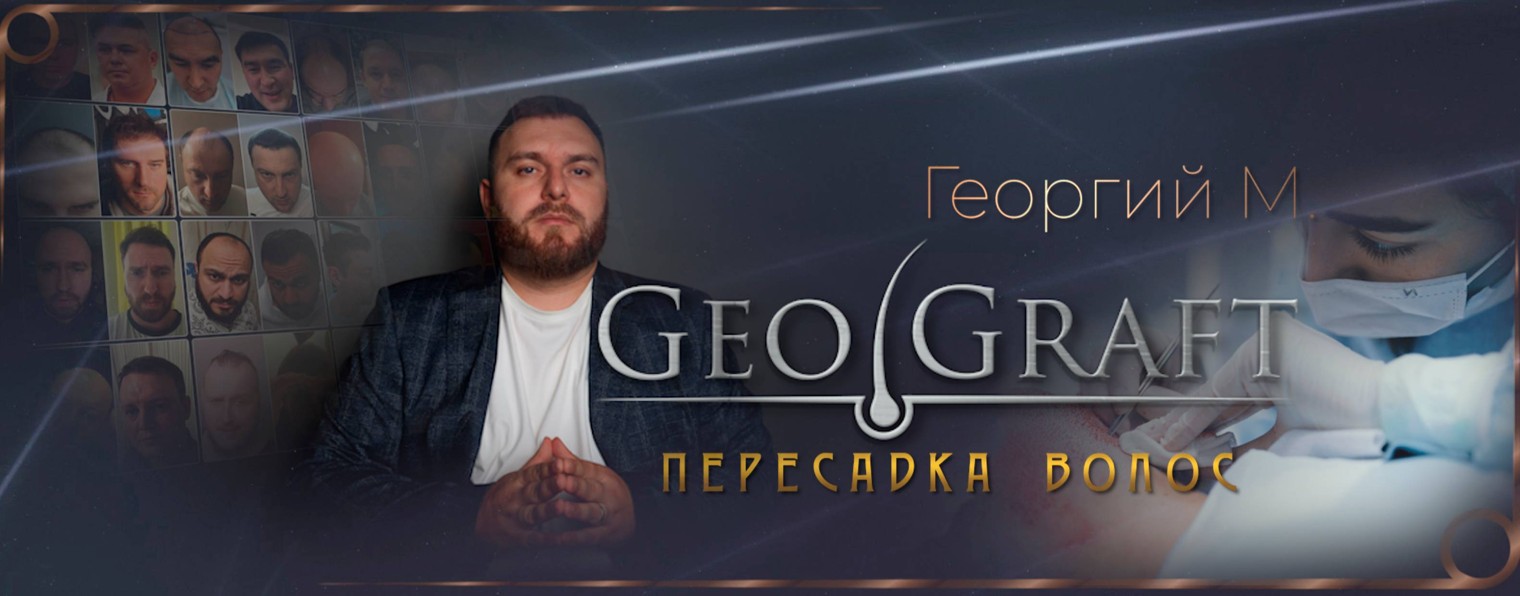 Георгий М ( Пересадка волос) ГеоГрафт