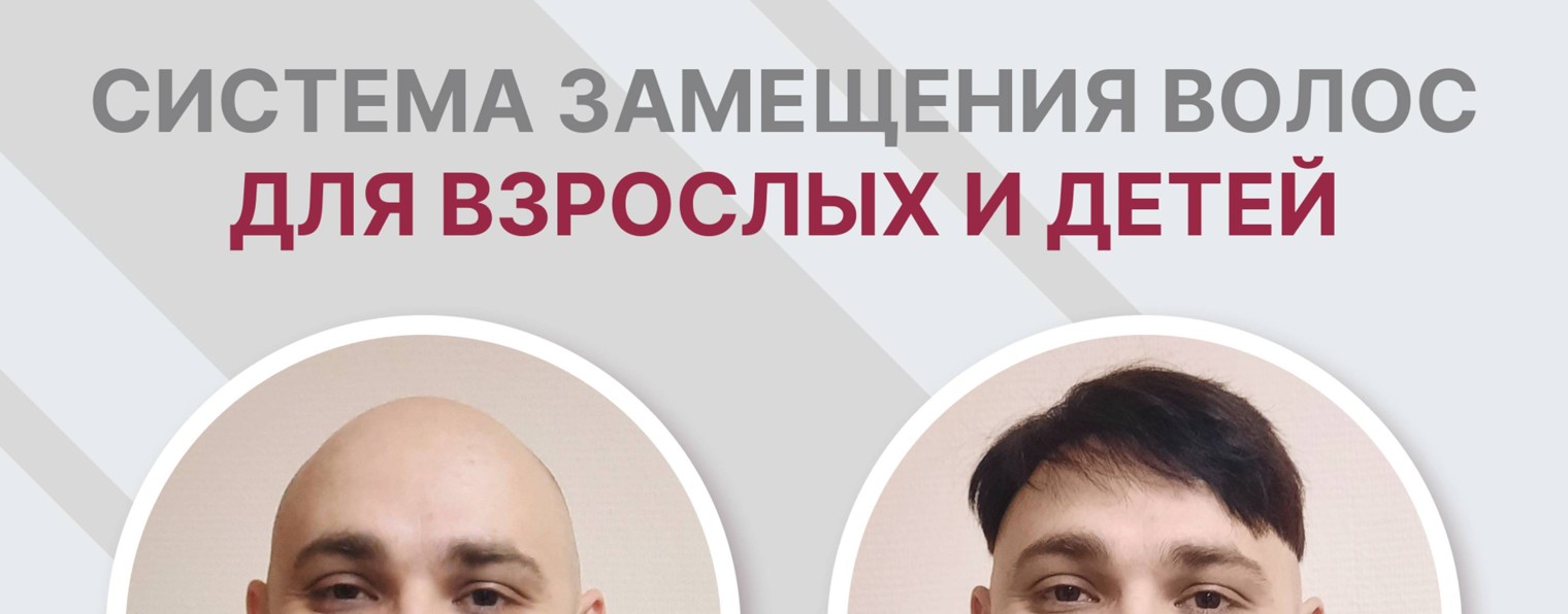 Системы замещения волос. ЦентрК33
