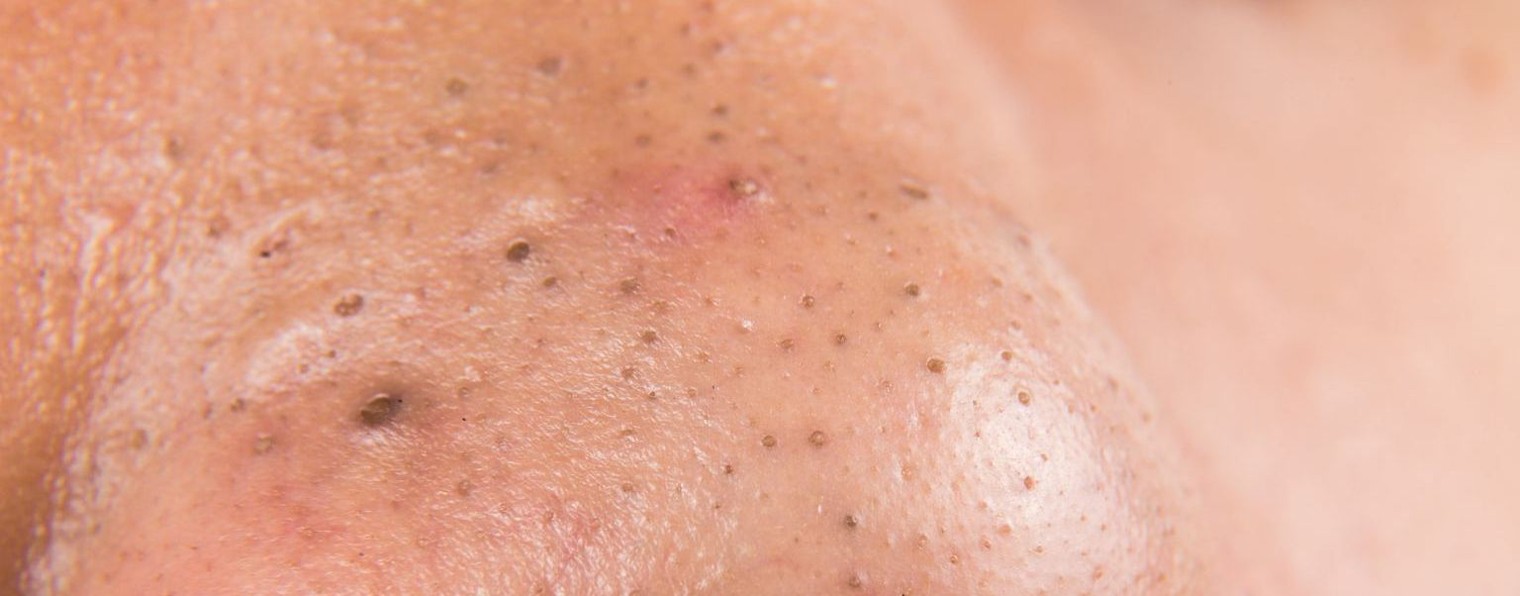 Лучшая подборка видео удаления прыщей.