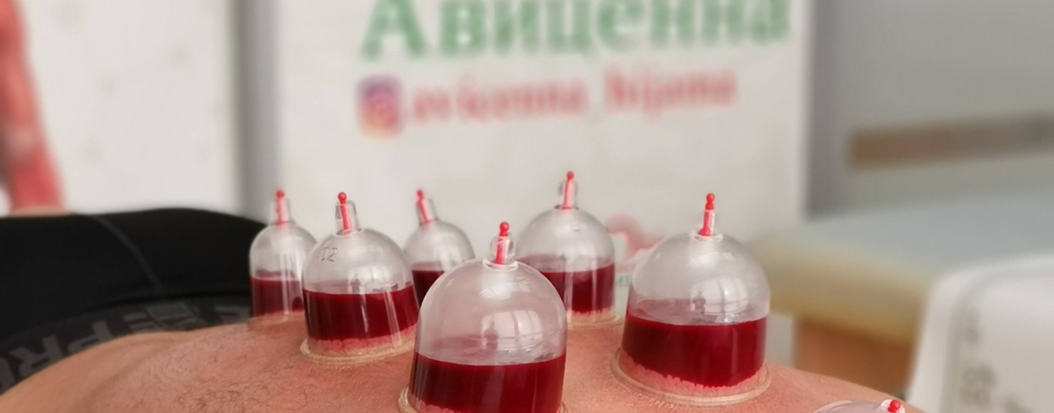 Хиджама Авиценна