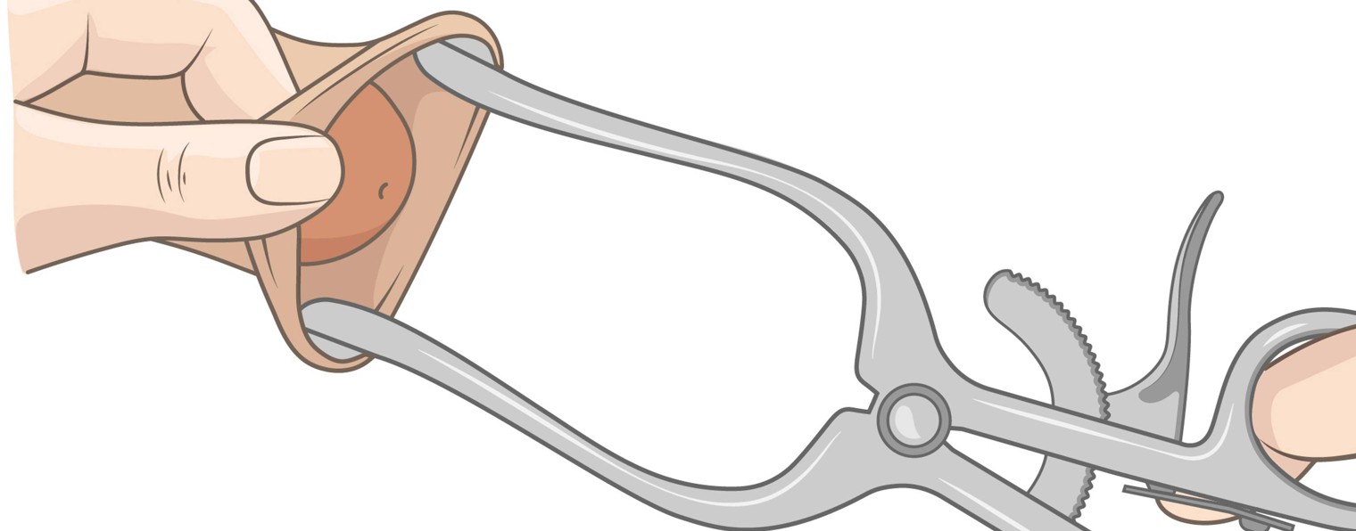 Растяжение крайней плоти при фимозе