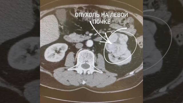 Рак почки. Опухолевое поражение левой почки
