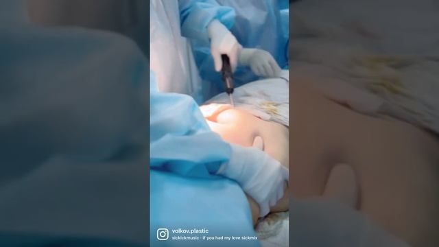 VASER-липосакция / Пластика тела / Пластическая хирургия