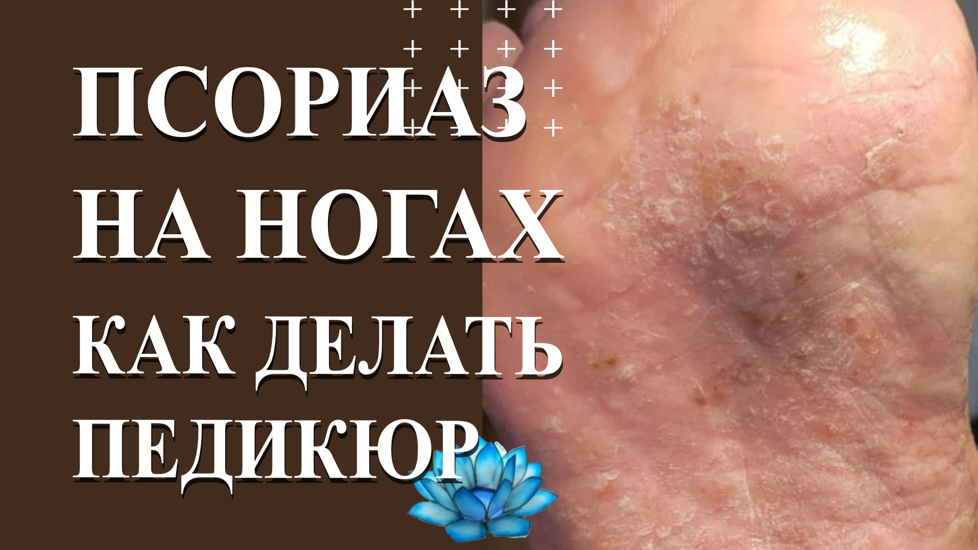 Псориаз на ногах. Как делать педикюр.