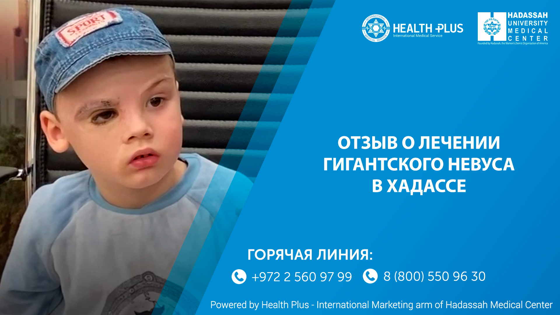 Отзыв об удалении гигантского невуса в Хадассе