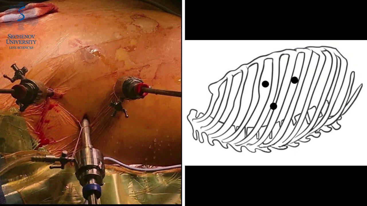 Miniinvasive total autopericardial aortic valve replacement with toracoscopic pericardial harvest
