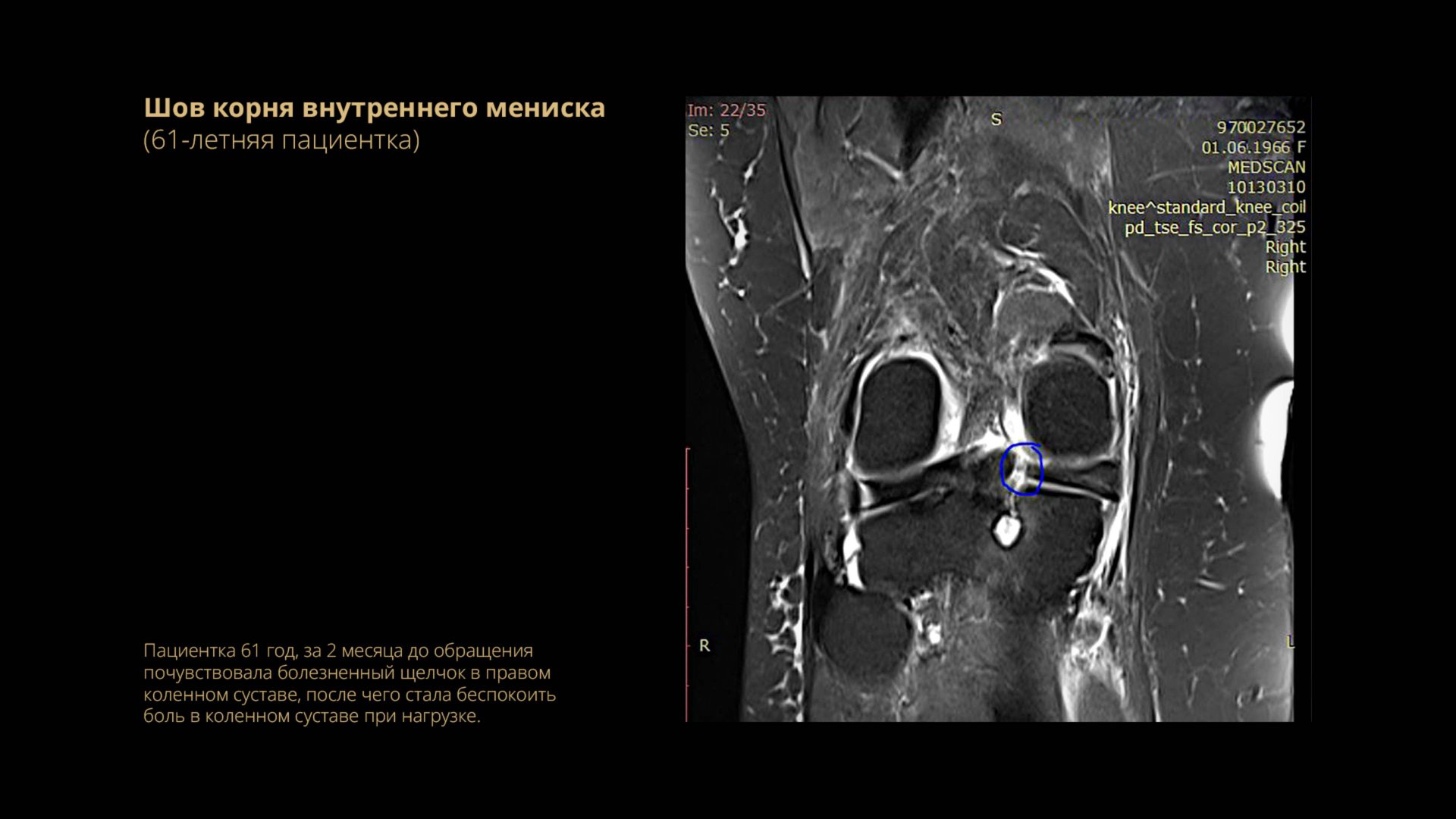 Шов корня внутреннего мениска (61-летняя пациентка)