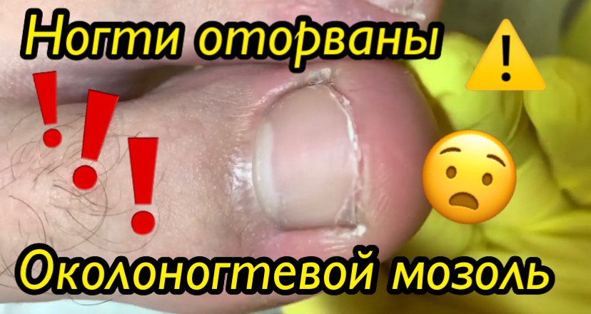 Ногти оторваны??⚠️ • Околоногтевой мозоль??❗️?