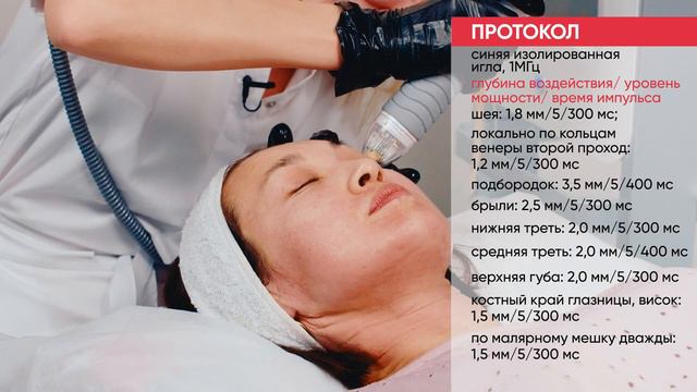 RF-лифтинг VIVACE. Кейс: Гульшат, 42 года, деформационный тип старения