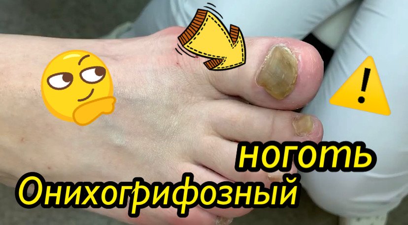 Онихогрифозный ноготь????⚠️ • Зачистка??
