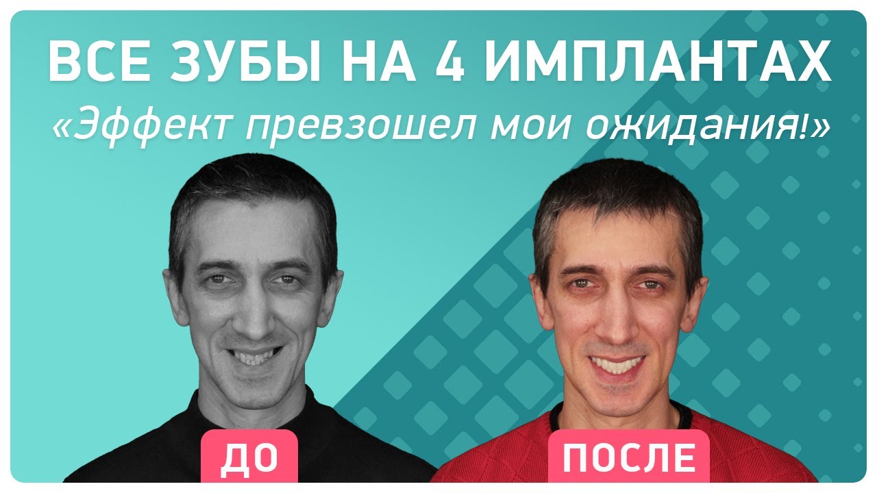 Новая улыбка за 1 день и навсегда! Этапы имплантации Pro Arch от Straumann