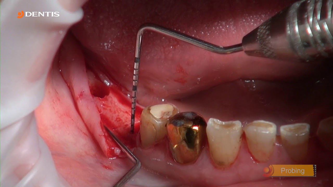 Др. Шумовский Д.Б. Имплантация  в области 46 и 47 зубов, менеджмент мягких тканей.