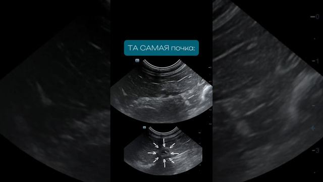Та самая почка на УЗИ, после выведения которой жизнь поделится на ДО и ПОСЛЕ