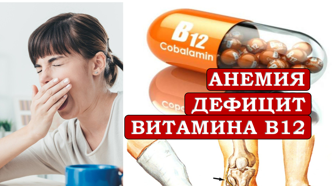 Анемия. Как распознать дефицит витамина В12.mp4