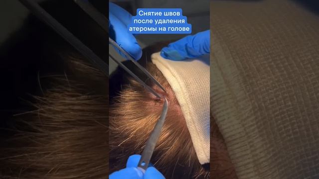Снятие швов после удаления атеромы на голове