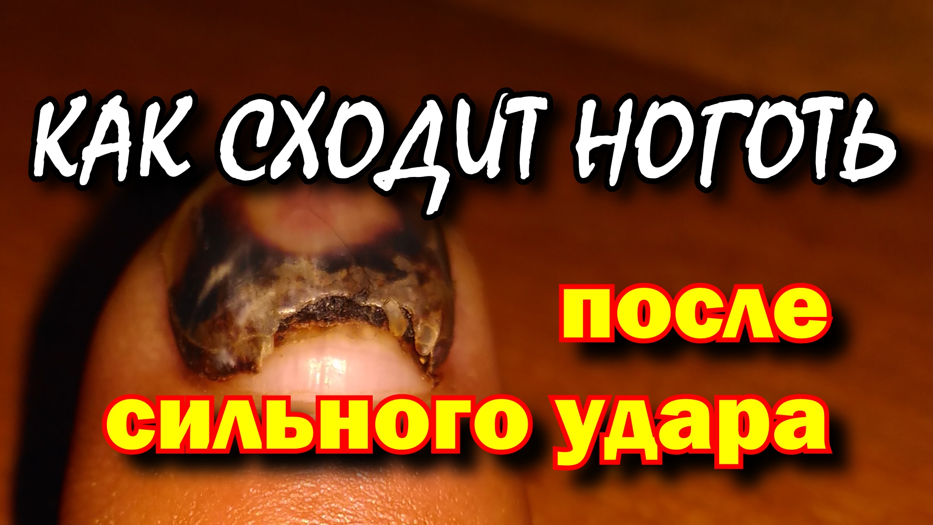 Как сходит ноготь после сильного удара