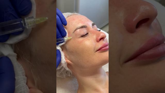 Atlantis classic - процедура