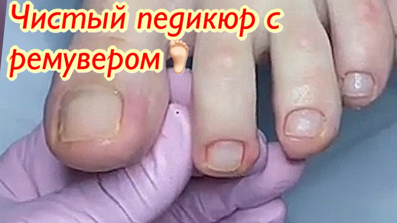 Чистый педикюр с ремувером