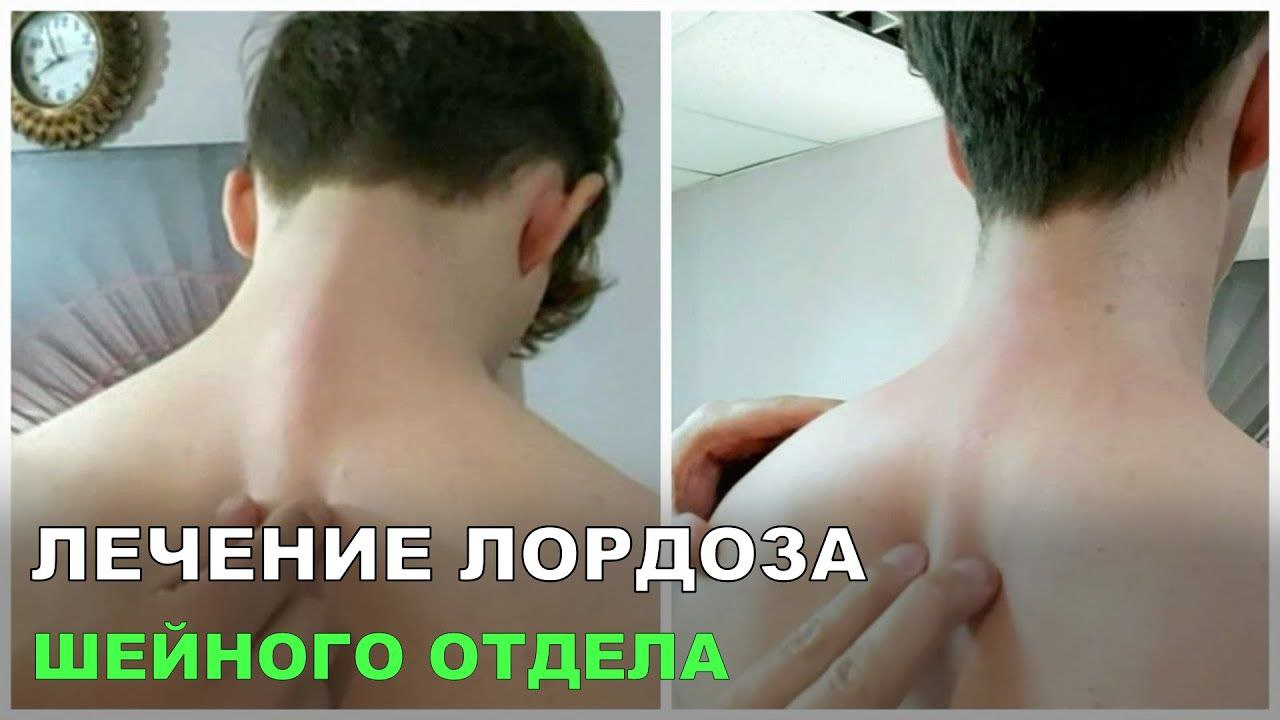 Лечение лордоза шейного отдела позвоночника. Вправляем весь позвоночник!