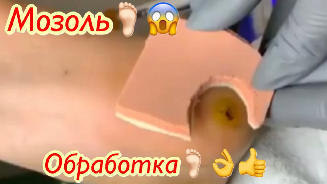 Мозоль??• Обработка???