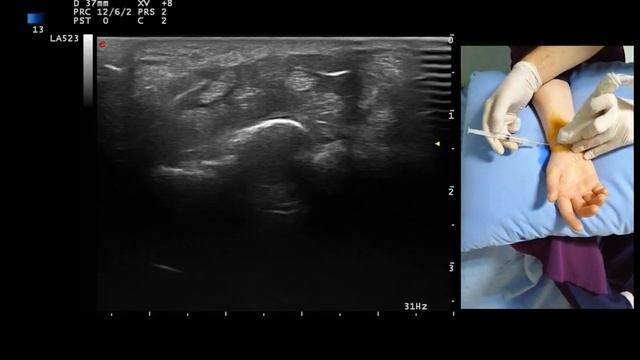 Инъекции при карпальном синдроме ( by Murat Karkucak MD)