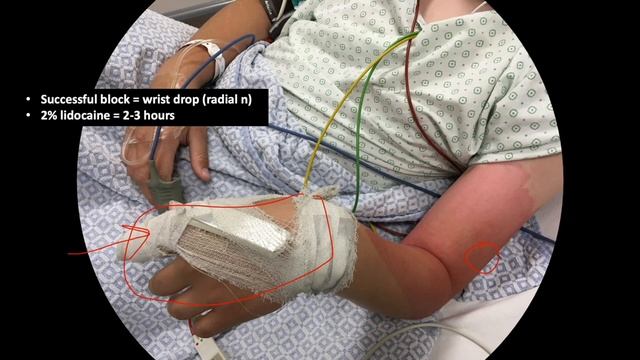 Блокада лучевого и срединного нерва