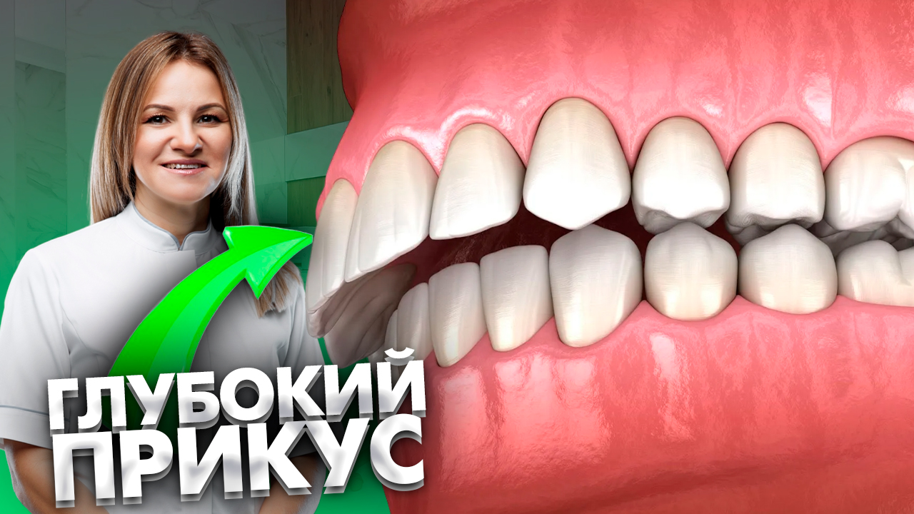 Десневая улыбка с глубоким прикусом (Клинический случай). Стоматолог в Сочи. Консультация.