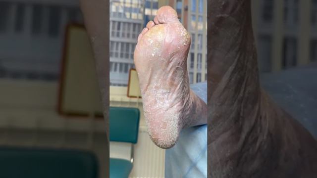 Грибок стопы, лечение. Микоз, удаление. Подолог Симферополь.