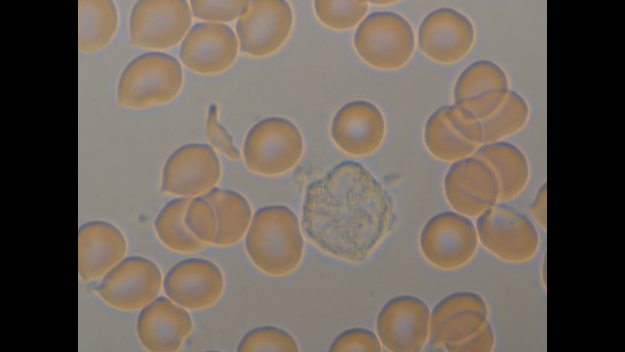 Эритроциты, Пойкилоцитоз, шизоцит, нейтрофил под микроскопом Микмед 6 в 7 гемосканирование