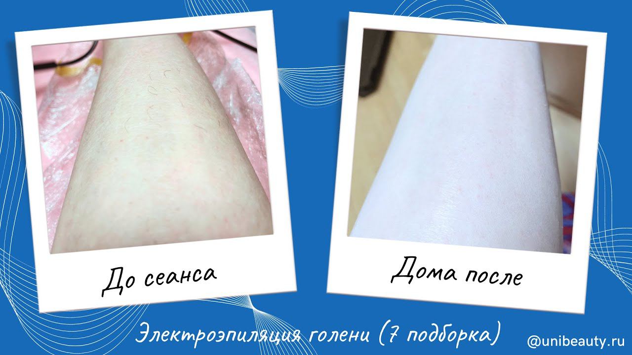 Электроэпиляция ног методом blend