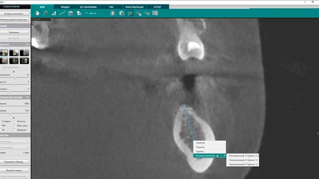 Установка виртуального импланта по месту измерения