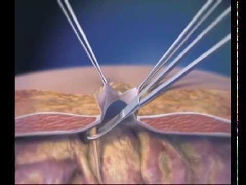 Синтетический пресс: новинки герниологии