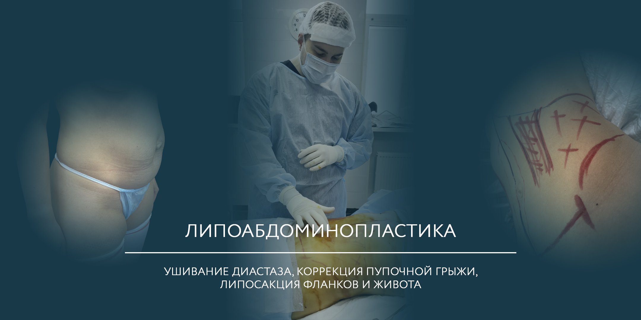 Липоабдоминопластика с ушиванием диастаза и коррекцией пупочной грыжи