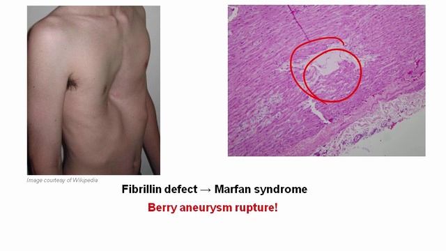 USMLE RX - 1.Биохимия - 1.Клеточная - 8.Эластин