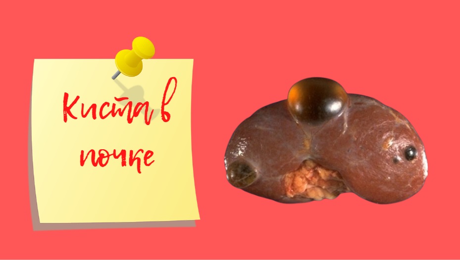 Киста в почке | Как избавиться без операции?