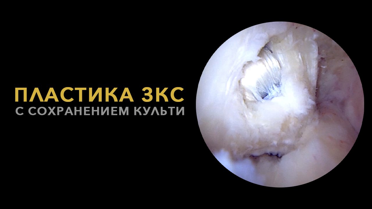 Артроскопическая пластика задней крестообразной связки (ЗКС) с сохранением культи.