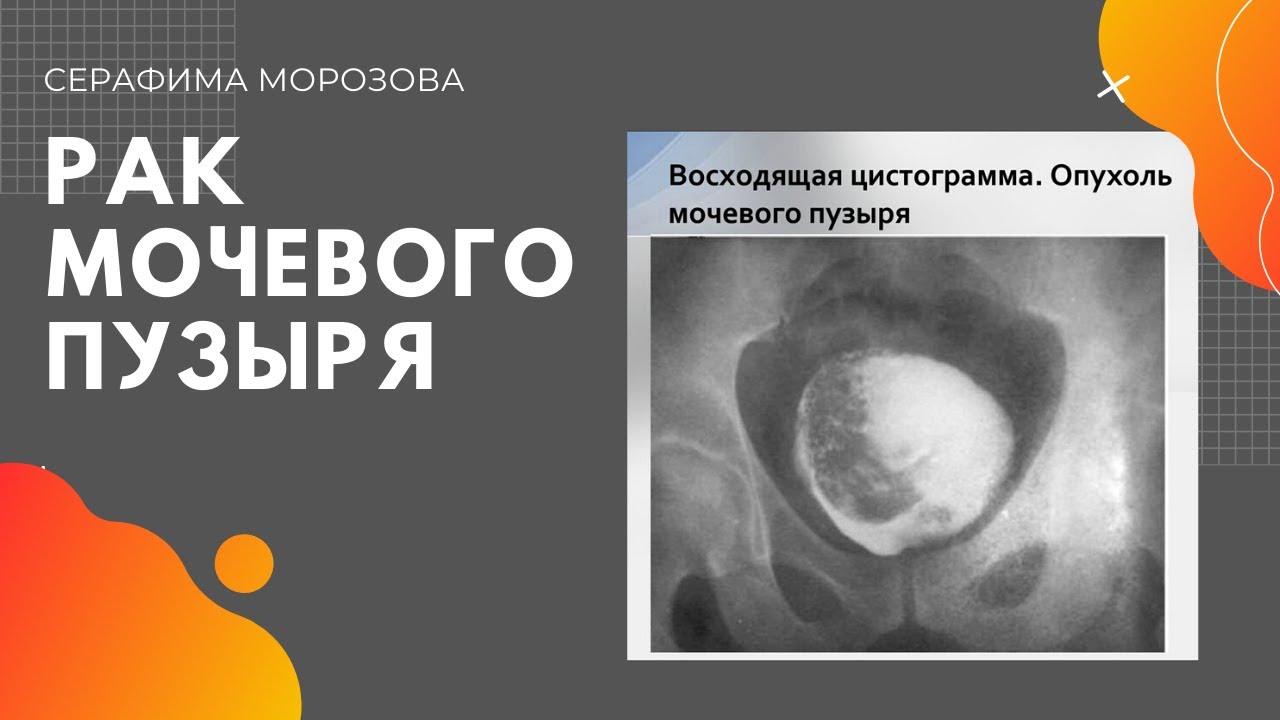Рак мочевого пузыря.mp4