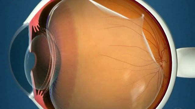 Отслойка стекловидного тела