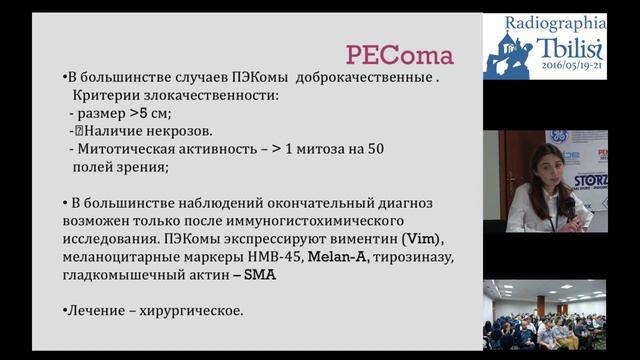 ПЭКома (периваскулятраня эпителиоидно клеточная опухоль). Лучевая диагностика