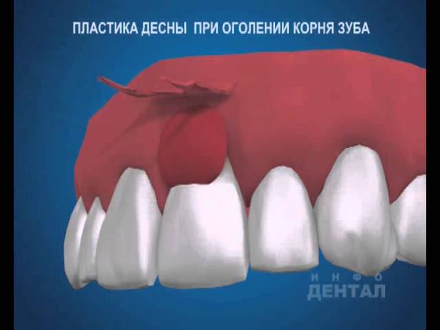 Пластика рецессии