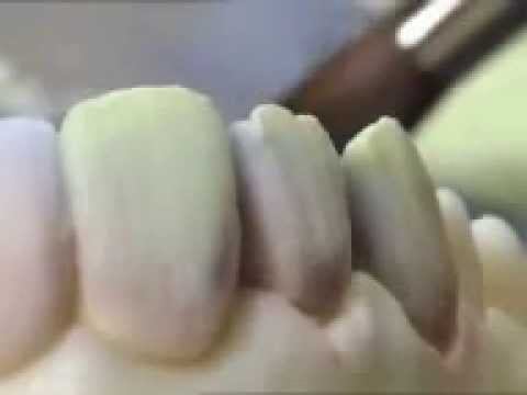 HeraCeram на драг.сплаве. Navigator ( Инкризеры, Инхэнсеры, и т.д.)