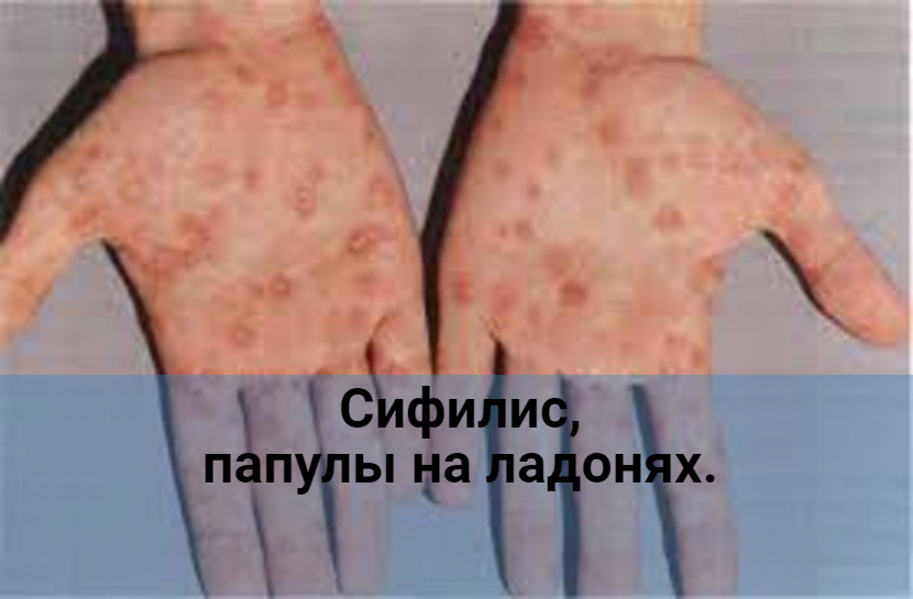 Сифилис, папулы на ладонях.
