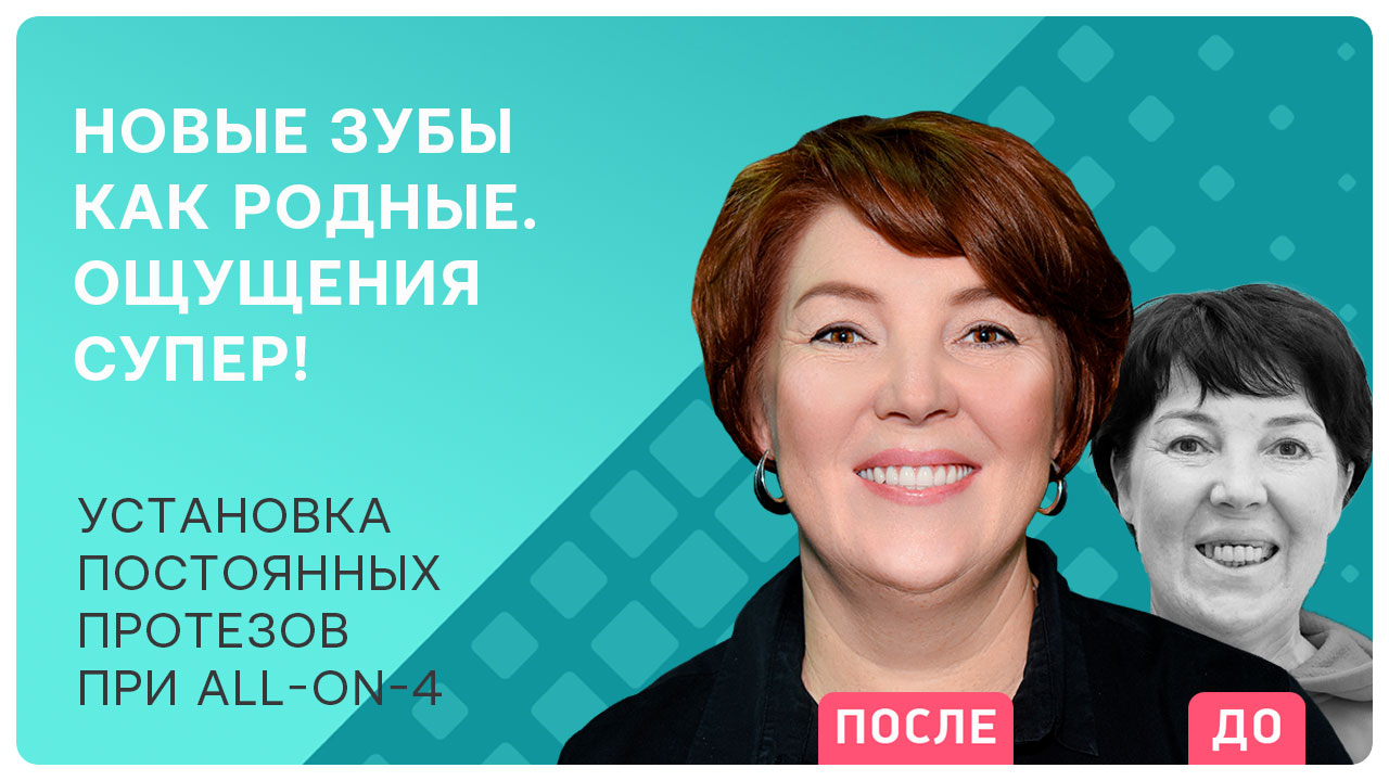 Этапы установки постоянных протезов при all-on-4