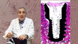 Остеоинтеграция. Первичная и вторичная стабильность имплантата.