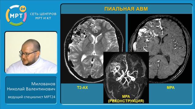 Ангиодисплазия головного мозга на МРТ