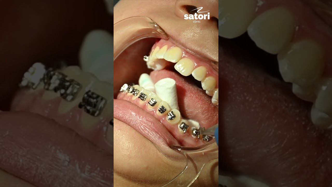 Фиксация брекетов