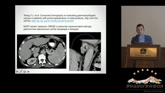 Лучевая диагностика портальной гипертензии